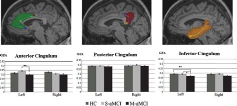 The Regions Of Interest Placements Reconstructed Tracts And General