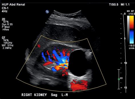 A Point Of Care Ultrasound Pocus Artifact Mimicking An Aortic