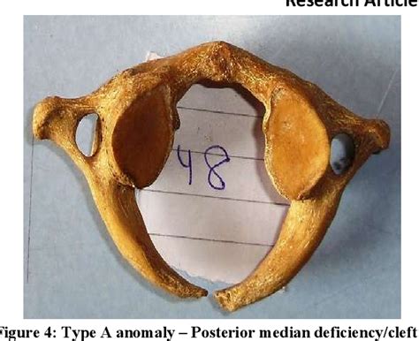 Figure 2 From Posterior Arch Anomalies Of Atlas And Its Clinical