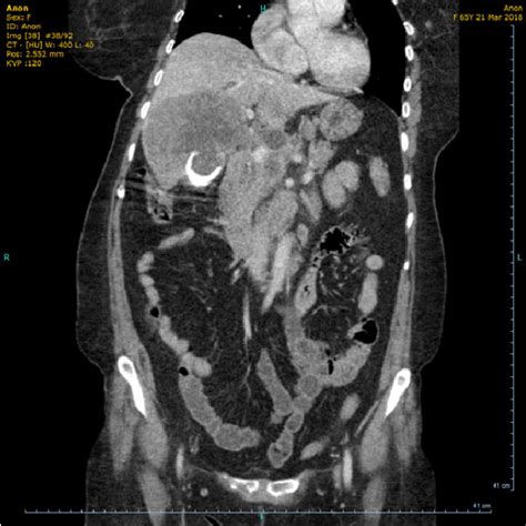 Ct Coronal View Showing Circumferential Calcification In The