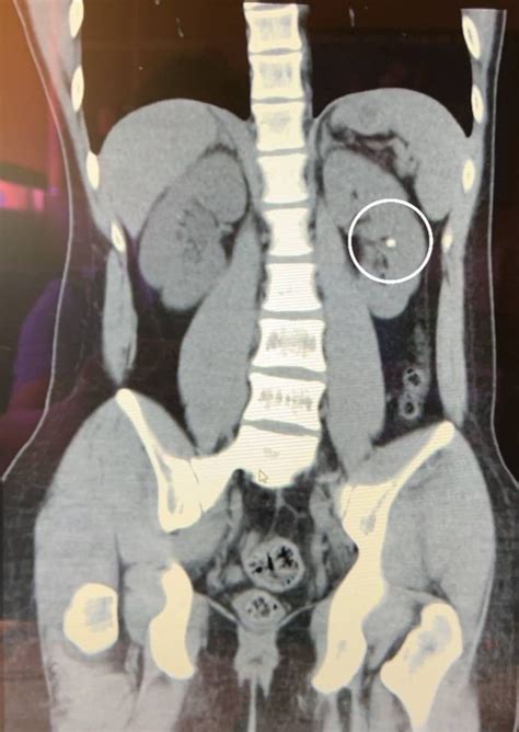 [新聞] 19歲患者腰背痛看骨科 醫查竟是少喝水又憋尿致輸尿管結石 看板sex Ptt網頁版