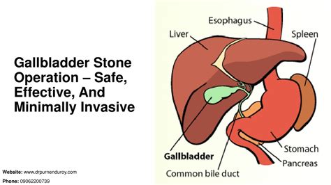 Ppt Gallbladder Stone Operation By The Best Laparoscopic Surgeon In