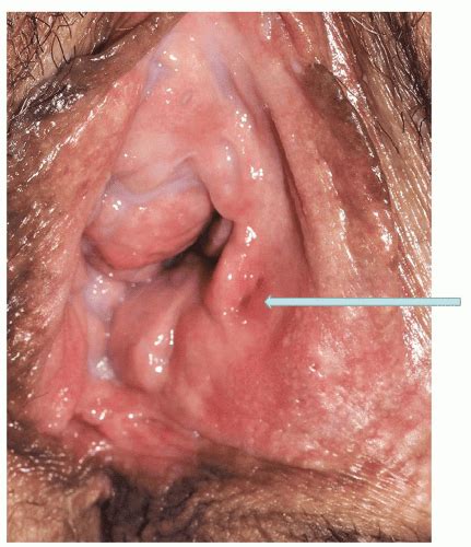 Genital Anatomy Obgyn Key