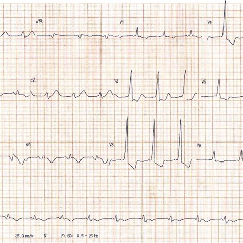 Wpw Pattern After Stent Angioplasty Download Scientific Diagram