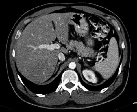 Radiopaedia Case Diffuse Hepatic Steatosis Id 16108 Study 15780 Nc
