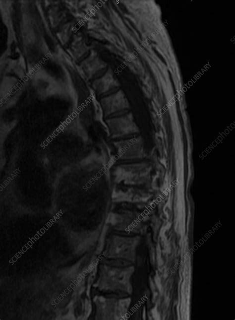 Thoracic Vertebrae Compression Fracture Stock Image C027 1223 Science Photo Library