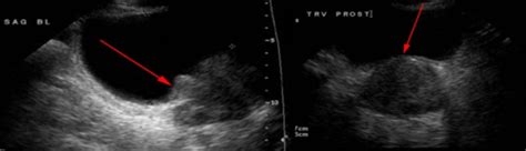 Prostate Flashcards Quizlet