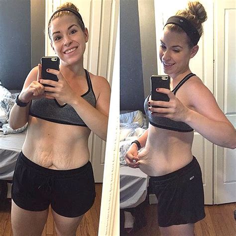 How Much Weight Loss Extra Skin At Susan Tucker Blog