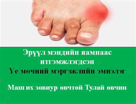 Маш хүчтэй зовиурлан өвддөг “Тулай”өвчнийг хэрхэн эмчлэх вэ