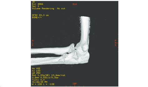 computed tomography three dimensional reconstruction download