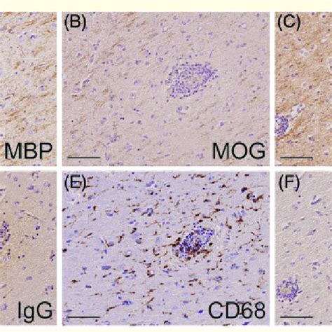 Pdf Myelin Oligodendrocyte Glycoprotein Antibody Associated Disease