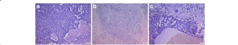 Triphasic Pattern Of Wilms Tumor A Predominant Blastemal Cells He