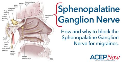 Sphenopalatine Nerve Block