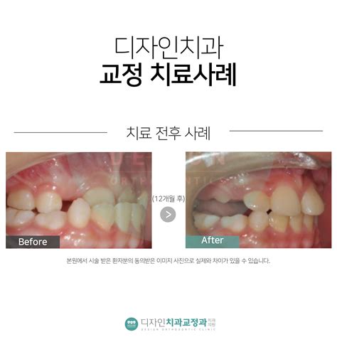 디자인치과교정과치과의원 소중한 우리 아이 무럭무럭 올바르게 자랐으면 하는 마음은 보호자분들 모두 Facebook
