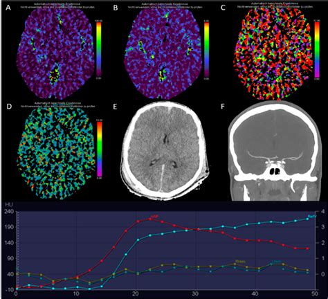 color coded maps generated from computed tomography perfusion ctp of