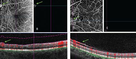 Vitreous Opacities Benign Or Serious