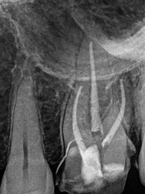 Root Resorption Root Canal Specialty Associates