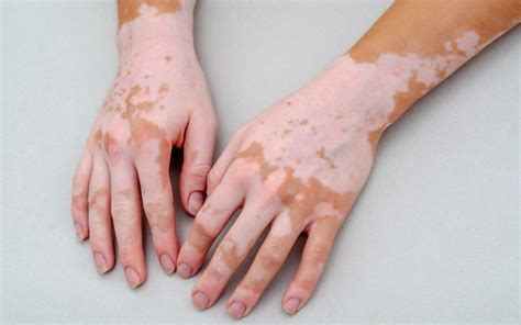 Vitiligo Penyakit Sopak Ini Yang Anda Perlu Tahu Mengenainya