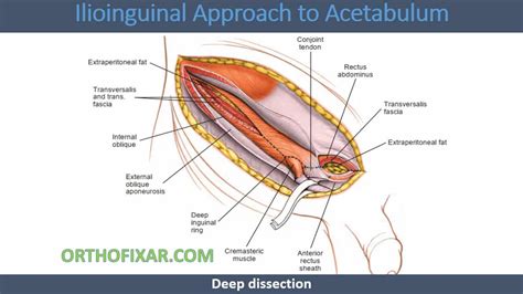 Ilioinguinal Approach To Acetabulum 2026 • Orthofixar