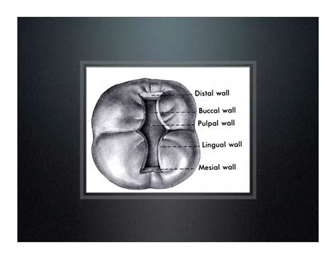 Amalgam Cavity Preparation Class I Pdf