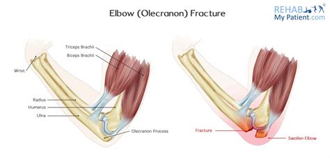 Elbow Olecranon Fracture Rehab My Patient Olecranon Bursitis Biceps Brachii Bursitis