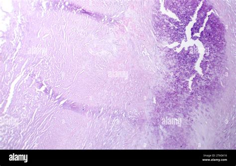 Photomicrograph Of Aortic Atherosclerosis Revealing Plaque Buildup And Narrowing Of The Aorta