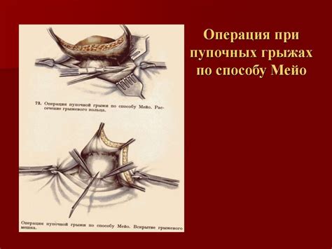 Грыжи живота - презентация онлайн