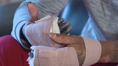 Foto Dikira Flu Biasa Ternyata Sepsis Pria Ini Berakhir Amputasi