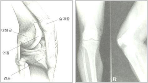 인공관절치환술이란 인공관절치환술이란