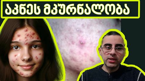 აკნე გამონაყარი სახეზე ყველაფერი რაც აკნეზე უნდა იცოდე Youtube