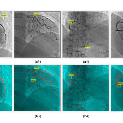 Example Of Stenosis Detection The Yellow Bounding Boxes Respect The Download Scientific