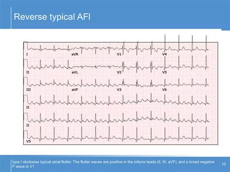 Atrial Flutter Afl Management Principals Pptx Ear Nose And Throat Conditions Diseases