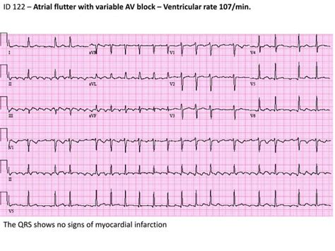 Stepwise Interpretarion Ecg 10 Ppt