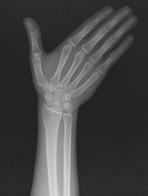 Scaphoid Tubercle