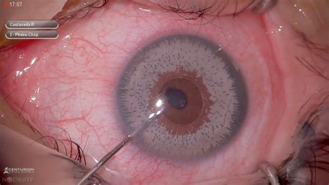 Iris Implant Removal Eyetube