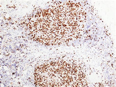 Follicular Lymphoma Pathology Outlines