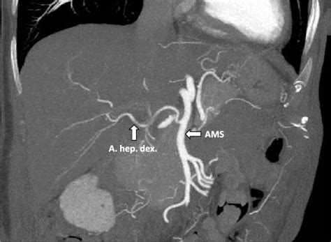 Right Hepatic Artery Radiology Hepatic Artery Gda Mbdr