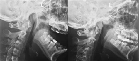 Temporomandibular Joint X Ray