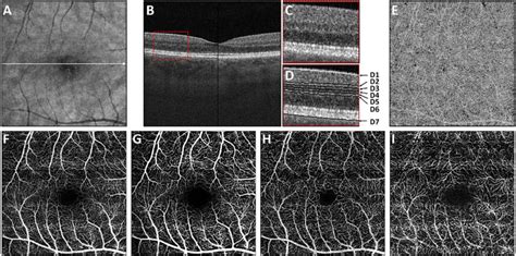 How Retinal Capillary Plexus And Choriocapillaris Images Are Generated