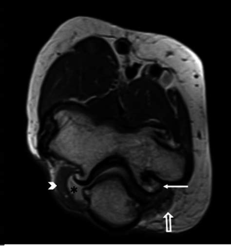 Primary Elbow Osteoarthritis Presenting As Ulnar Nerve Palsy With Claw