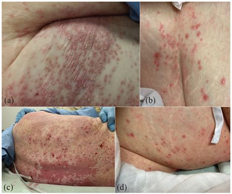 Candidiasis Skin Congenital Candidiasis A Rare And Unpredictable