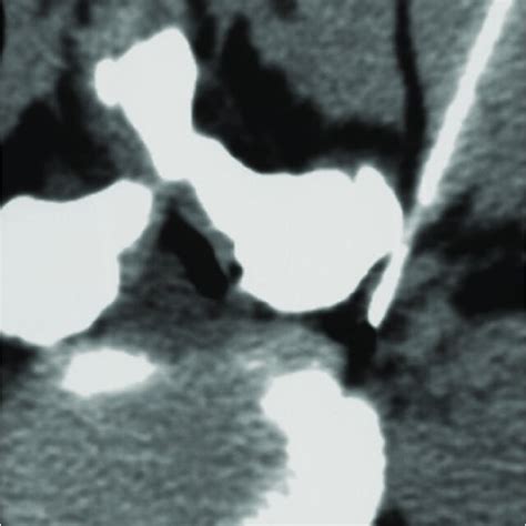 Ct Scan Check Of Needle Positioning Before Treatment By Steroid
