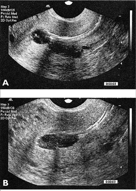 Sagittal Views Of A Normal Uterine Cavity On Sonohysterography Showing Download Scientific