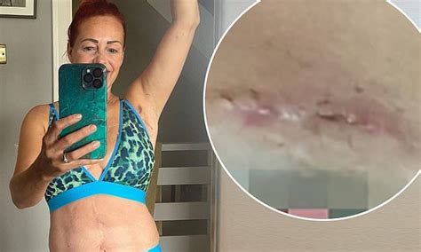 Sarah Cawood 50 Shows Off Her Very Neat Lumpectomy Scars Two Weeks