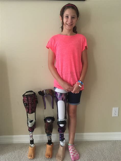 Rotationplasty — Robinson Osteosarcoma Fund