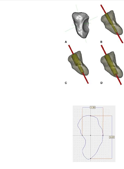 Influence Of Screw Design Sex And Approach In Scaphoid Fracture Fixation Pdf Download Available