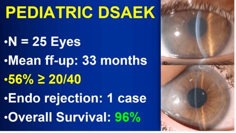多种板层角膜移植手术治疗儿童角膜疾病的临床探讨 研究 国际 结果
