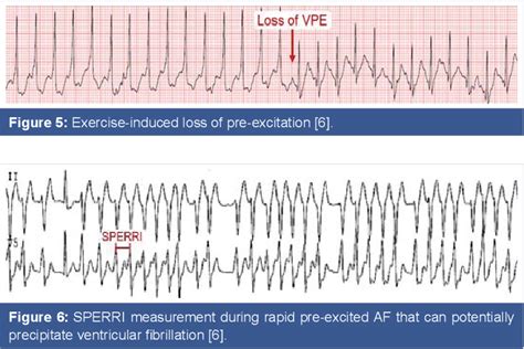 Figure 6 From A Wolﬀ Parkinson White Wpw Electrocardiographic Pattern In Asymptomatic Patient