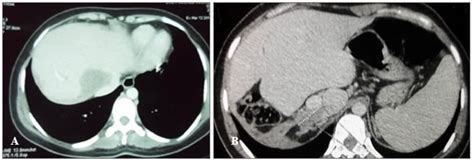 Ct Scan Showing An Involutedhydatid Cysts In Hepatic Dome A In