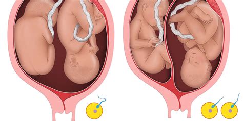 What Are Dichorionic Diamniotic Twins Are There Risks Involved In Multiple Births Cloudnine Blog